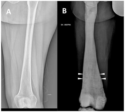 Skeletal Imaging Features In Osteopetrosis Encyclopedia Mdpi