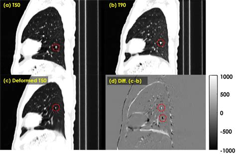Sample Outlier Results Deformed By The Fast Demons Algorithm Algorithm