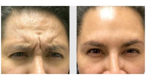 The Best Botox For Axillary Hyperhidrosis Bellevue And Kirkland