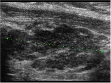 Head And Neck 41 Thyroid Gland Case 414 Thyroiditis And Diffuse
