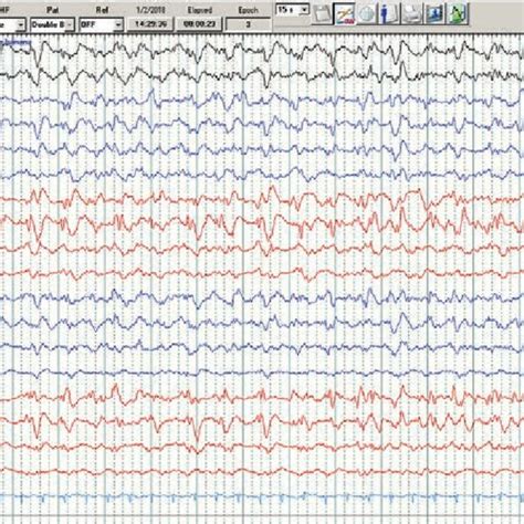 Continuous Electroencephalogram Segment For Case 2 Showing Burst Download Scientific Diagram