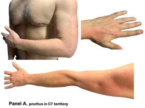 B213 Brachioradialis Pruritus As The Main Symptom Of Cervical