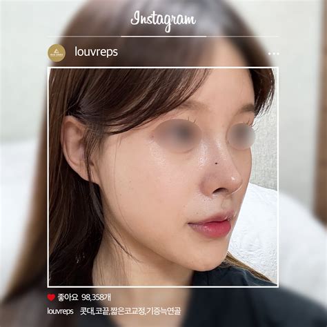 루브르성형외과 처음처럼 자연스럽게 전후사진후기셀카후기