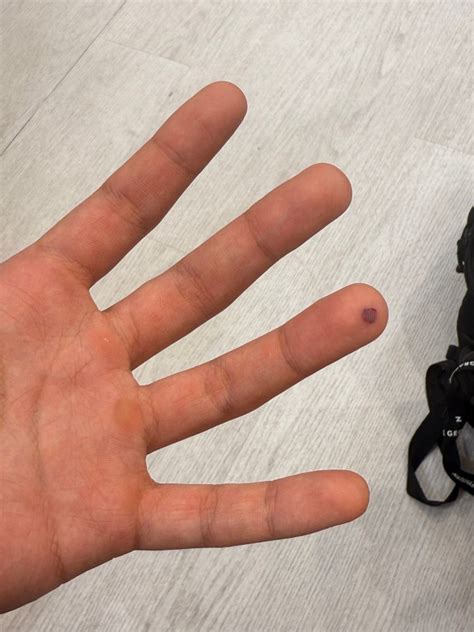 피부 조직 괴사 지식in