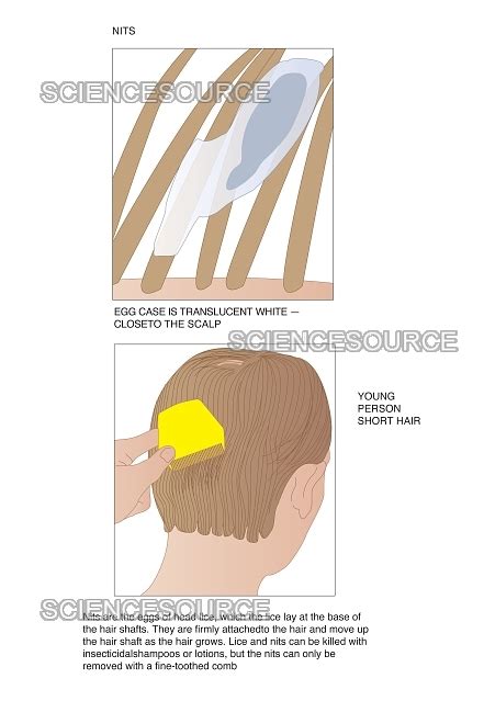 Head Lice Artwork Stock Image Science Source Images