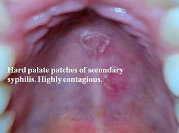 Gonorrhea Mouth Syphilis On The Face In Primary Care A Rare Sign Of