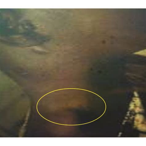 A Bubo On The Neck Of A Woman With Bubonic Plague Photo A J Santos