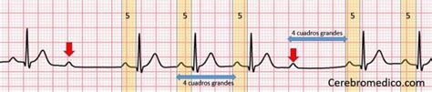 Bloqueos Auriculoventriculares Bloqueo Av De 1° 2° Y 3°