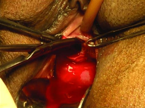 Left Lateral Vaginal Dissection Download Scientific Diagram
