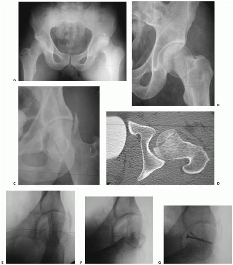 Fibrous Cortical Defect Nonossifying Fibroma Teachme Orthopedics