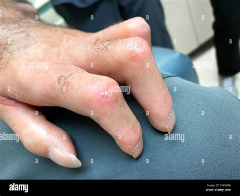Scleroderma Affecting A Hispanic Male Patient S Fingers Scleroderma
