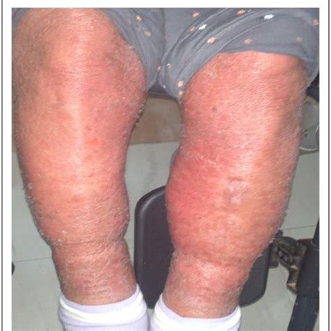 Diffuse Infiltrating Erythroderma Of The Lower Extremities Download