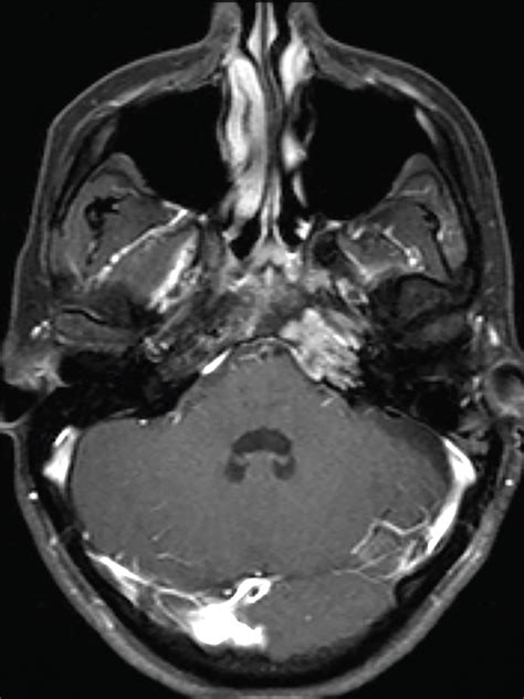Chondrosarcoma Definitive Radiosurgery After Subtotal Resections Radiology Key
