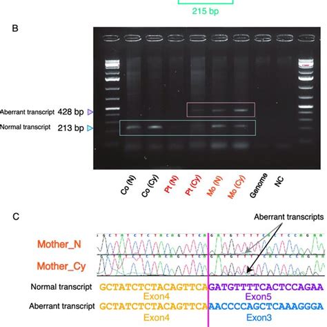 Assessment Of Nmd Of The Tandem Duplication Allele In Patient 1 And Her