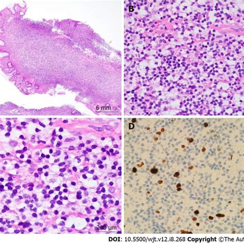 Post Transplant Lymphoproliferative Disorder Monomorphic Type Download Scientific Diagram