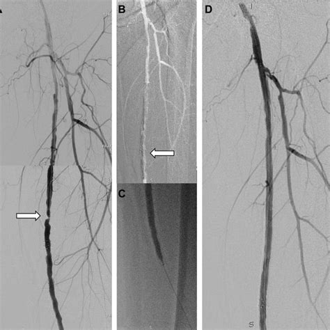 Left Sfa In Stent Restenosis Angioplasty Download Scientific Diagram