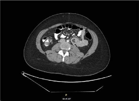 Ct Scan Showing 8 Cm Jejunal Intussusception Download Scientific Diagram