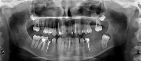 Upper Impacted Wisdom Tooth