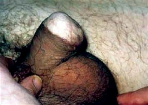 Post Glansectomy And Glanuloplasty Cosmetic Results Download Scientific Diagram