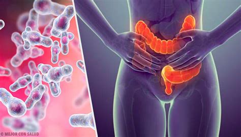 Colitis Microscópica Todo Lo Que Debes Saber Mejor Con Salud