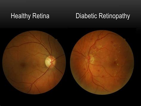 Ppt Diabetic Retinopathy Powerpoint Presentation Free Download Id