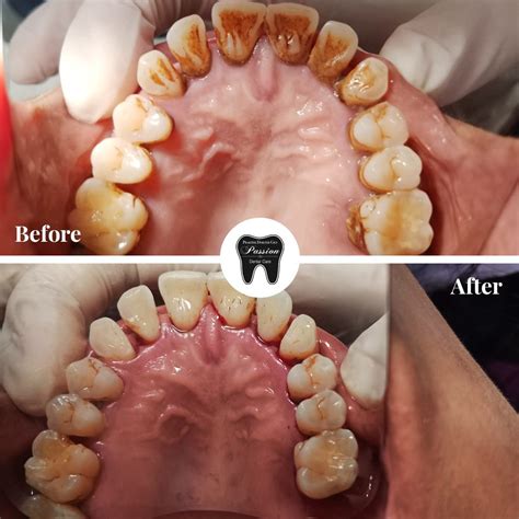 Dental Polishing After Scaling At George Redden Blog
