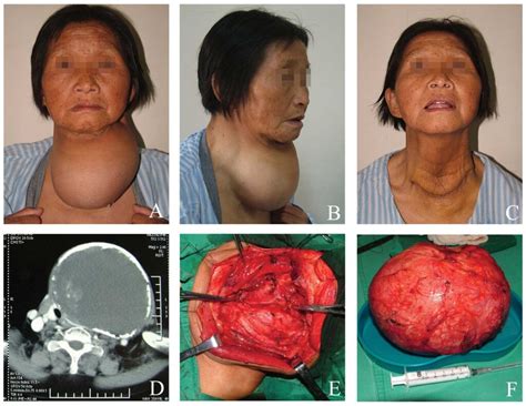 Thyroid Swelling Thyroidectomy Surgery Dr Rahul Rathod General Surgeon And Laparoscopic