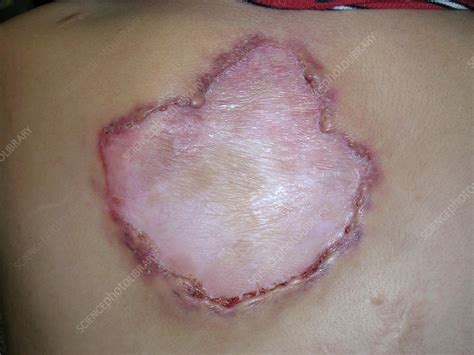 Pyoderma Gangrenosum Treated With Infliximab Stock Image C056 2649 Science Photo Library