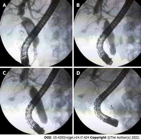Figure 1 From Feasibility Of Endoscopic Papillary Large Balloon Dilation To Remove Difficult