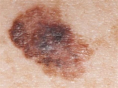 Cancerous Moles What Do They Look Like