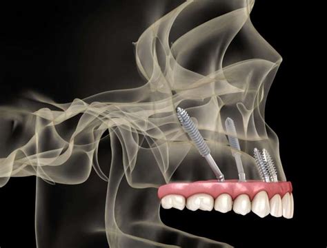 Zygomatic Implants London No1 Clinic Dulwich Dental Office