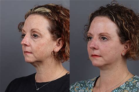 Eyelid Surgery Before And After Patient 32 Dr Marotta