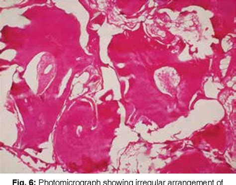 Figure 1 From Complex Odontoma Intraosseous Type Associated With Mandibular Impacted Permanent