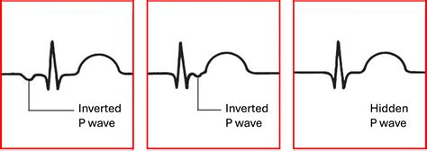 Junctional Arrhythmias Ekg Essentials A Student Handbook