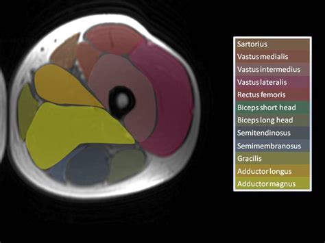 Vastus Medialis Oblique Mri