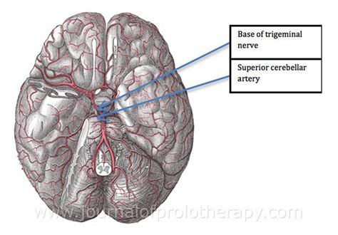 Treatment Of Trigeminal Neuralgia Utilizing Neural Prolotherapy A Case Report Artofit