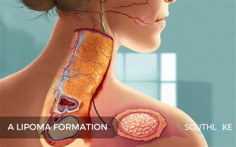 Lipoma Reasons Causes Symptoms Types Treatments Southlake General