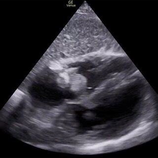 Pointofcare Ultrasonography In Subxiphoid View With Large Tricuspid Download Scientific