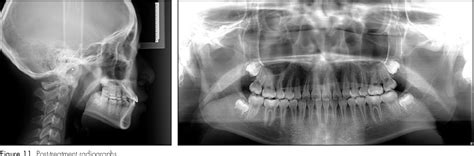 Figure 11 From An Asymmetric Magnetic Reverse Twin Block Applian Ce For The Treatment Of A