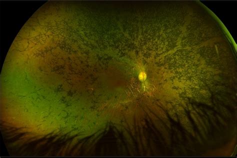 Pigmentary Retinal Dystrophy Retina Image Bank