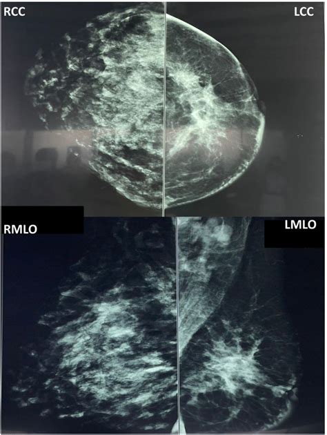 Patient 3 Mammogram Showing Heterogeneously Coarse Nodular And Download Scientific Diagram