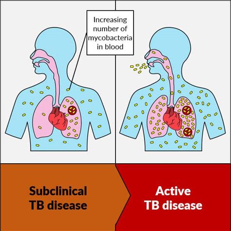 Words Matter How A Shared Language Will Accelerate Development Of Tb Diagnostics Pbd Biotech