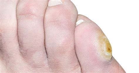 Eelt Verwijderen Op Voeten Drs Leenarts