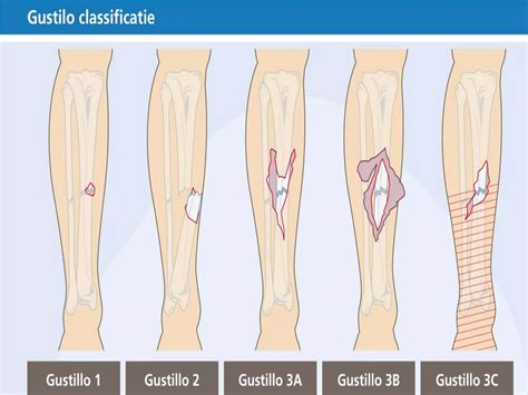 Classification Of Fractures And Compound Fracture Managment Pptx