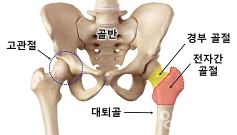 [건강의학칼럼] 100세 시대의 아픔 고관절 골절