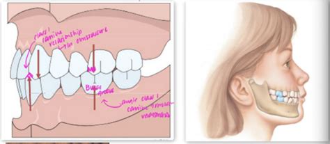 Occlusion Flashcards Quizlet