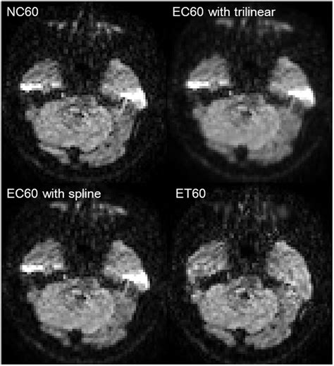 Representative Diffusion Weighted Images With The 60 Directions Download Scientific Diagram