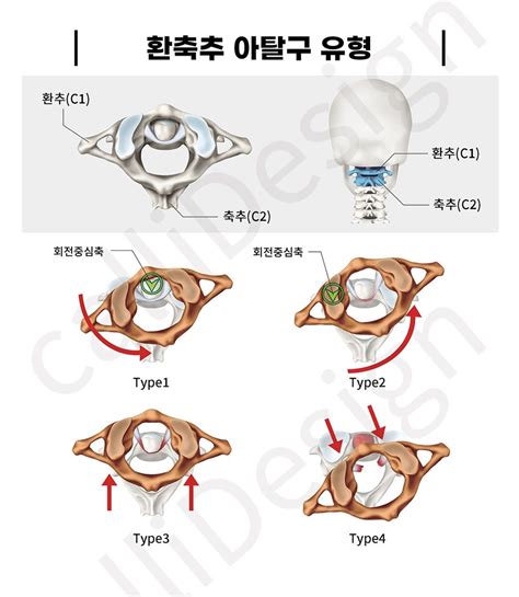 의학그림 메디컬 일러스트 Callidesign On Instagram 환축추 아탈구 유형을 설명하는 메디컬일러스트 입니다 프로필 링크 주소 Ctee Shop에서 만나실