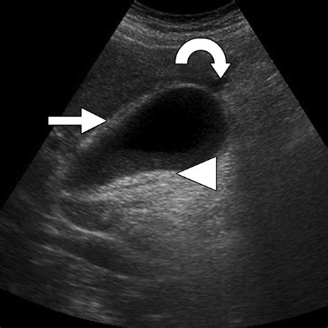 Acute Cholecystitis Ultrasound