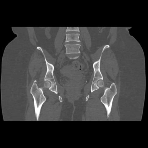 Gluteal Calcific Tendinitis Calcified Tendinopathy Of The Gluteus